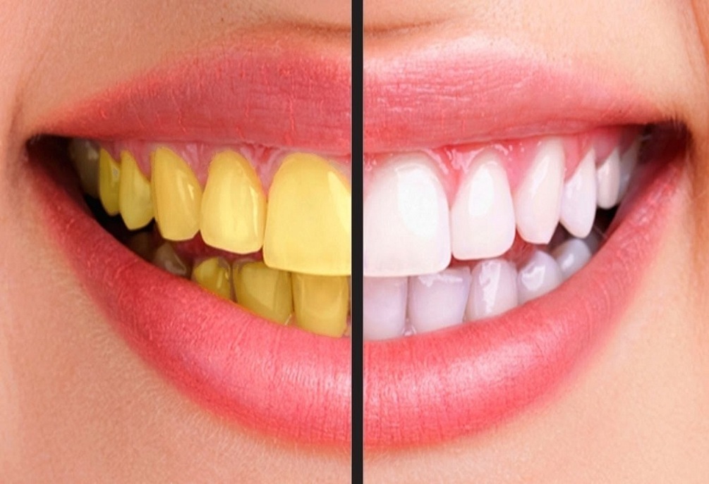 White smile, color is adjusted by slider Spark ar (instagram)