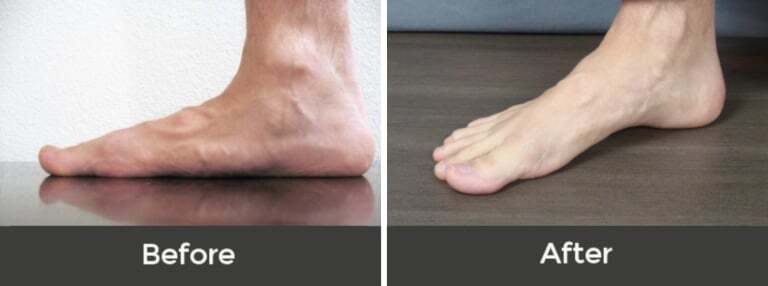 Fix Your Feet, Fix Your Life: The Ultimate Guide to Correcting Flat Feet