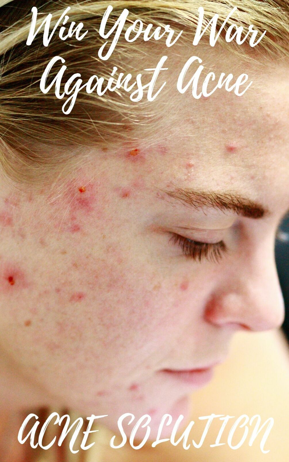 How to Win Your War Against Acne