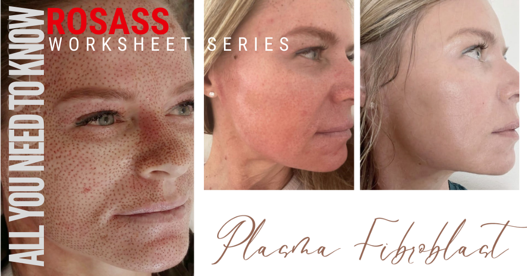 Plasma Fibroblast Full Face lift - ROSASS by Susan Mouton