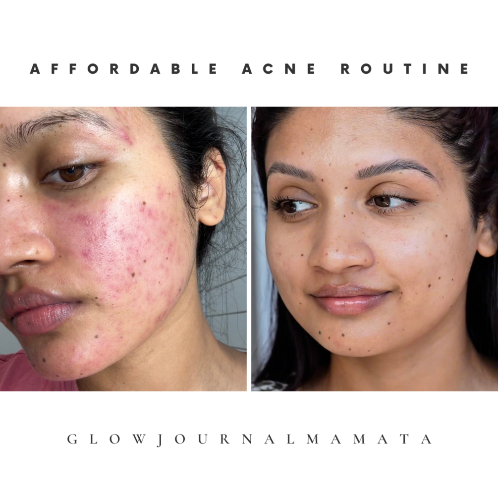The Affordable Acne Routine That Works