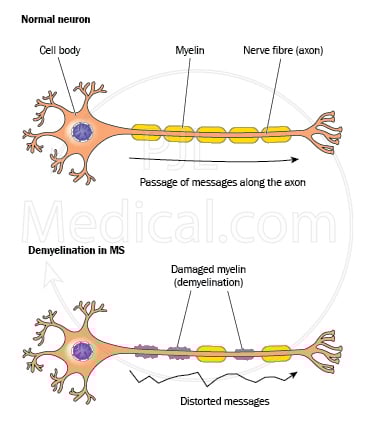 Multiple sclerosis demyelinated axon