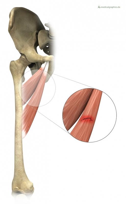 Illustration Adduktorenzerrung / Strained groin