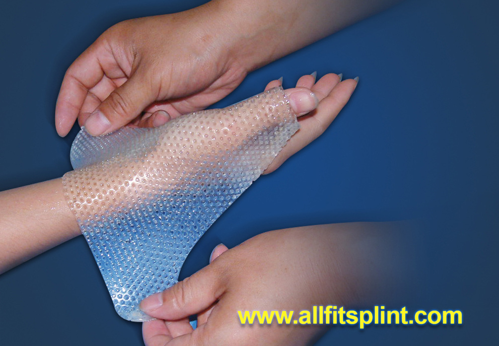 thermoplastic splint
