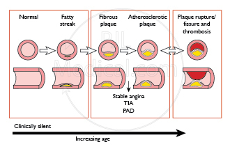 Development of atheroma