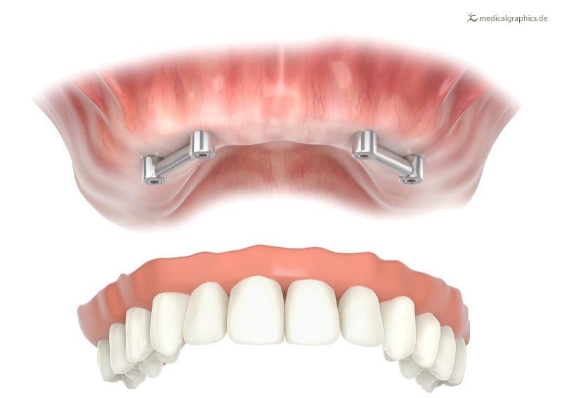 Illustration Stegprothese Oberkiefer / Bar retained full prosthesis ...