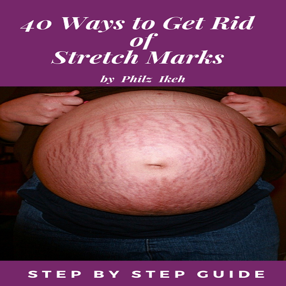 40 Ways to Get Rid of Stretch Marks - Gumroad
