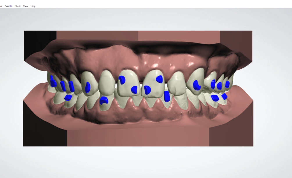3D Clear Aligner Orthodontic Planning